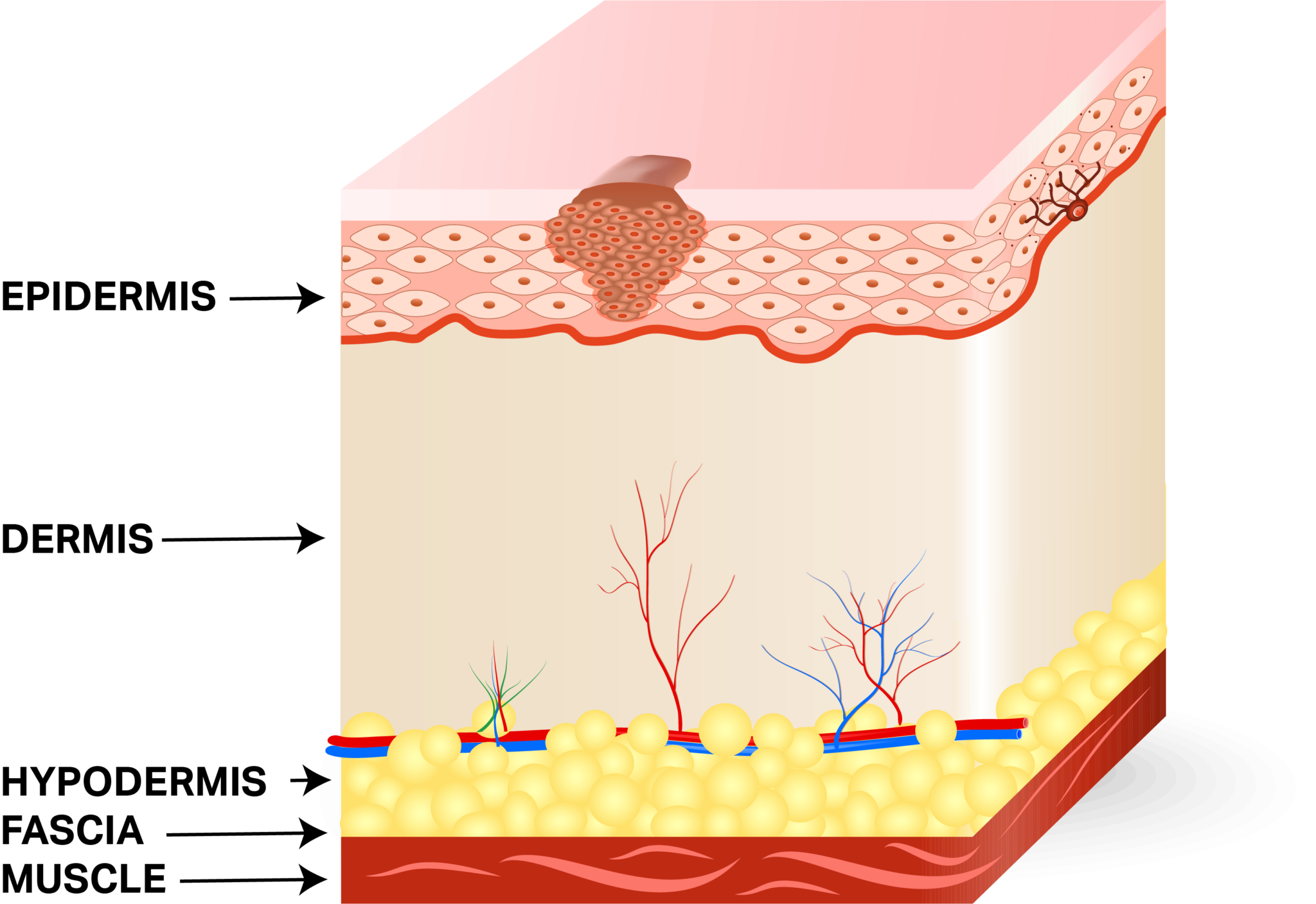 Treating Squamous Cell Skin Cancer: By Stage – Skin Cancer Education ...