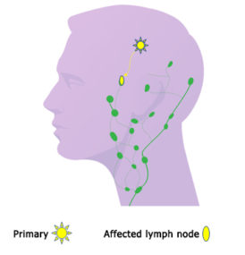 Staging Squamous Cell Skin Cancer: A Practical Description – Skin ...